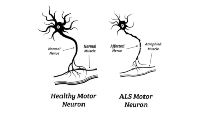 Physiotherapy Treatment for ALS Symptoms - Propel Physiotherapy
