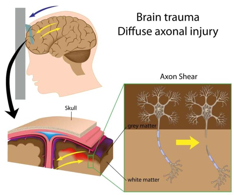 Diffuse Axonal Brain Injury: Causes, Symptoms, Treatment
