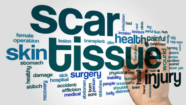 Acupuncture for Scar Tissue Treatment - Propel Physiotherapy