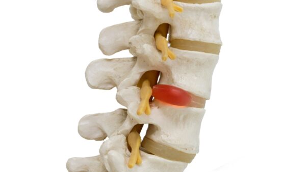 Discectomy: Purpose, Post-Operative Pain Management & Rehabilitation