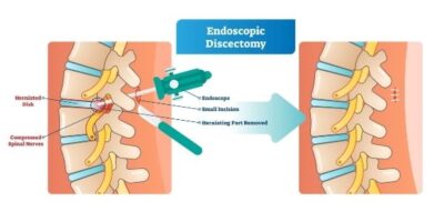 Discectomy: Purpose, Post-Operative Pain Management & Rehabilitation