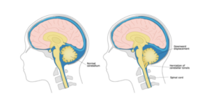 Chiari Malformation Treatment - Propel Physiotherapy