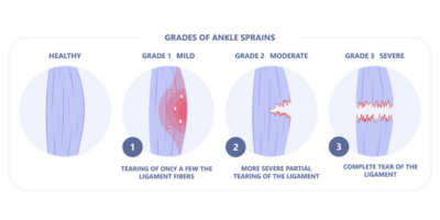 Ankle Sprain Physiotherapy - Propel Physiotherapy