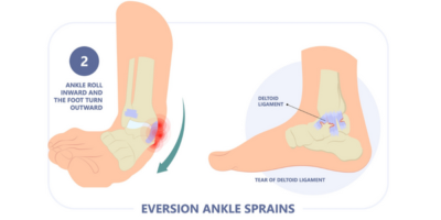 Ankle Sprain Physiotherapy - Propel Physiotherapy