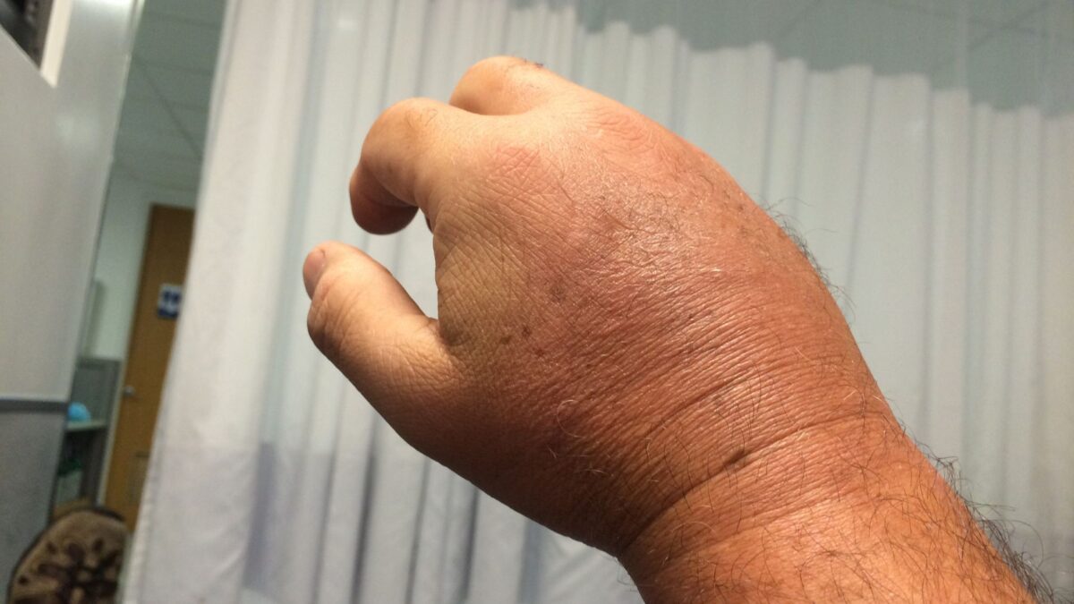 CRPS Treatment - Propel Physiotherapy