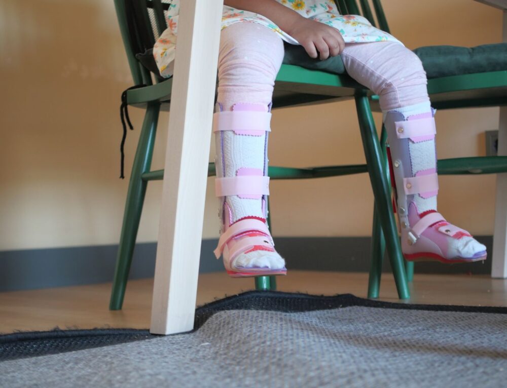 Club Foot Treatment and Prognosis - Propel Physiotherapy