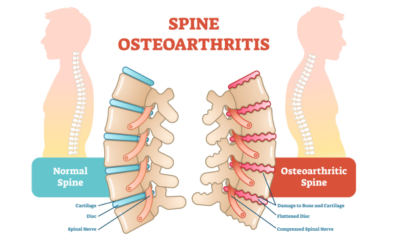 Spine OA: How Exercise Can Help Manage Symptoms - Propel Physiotherapy
