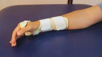 Splinting: Types, Uses and Fabrication - Propel Physiotherapy