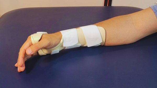 Splinting: Types, Uses and Fabrication - Propel Physiotherapy