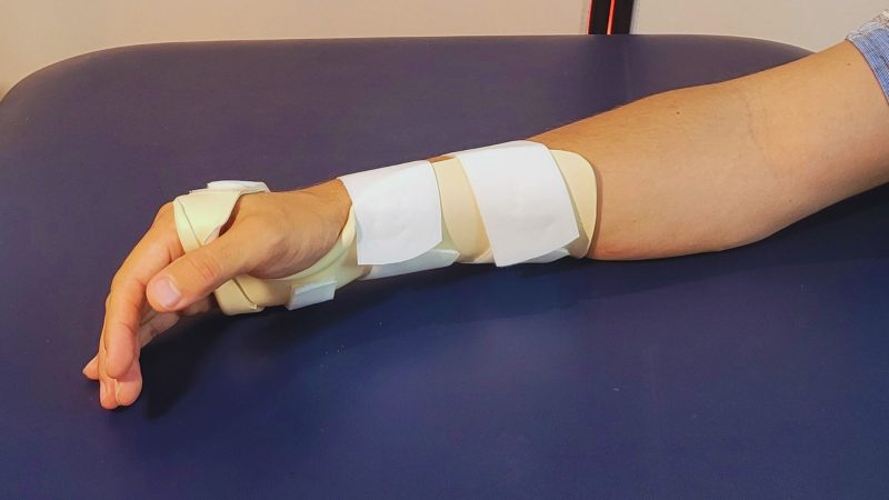 Splinting: Types, Uses and Fabrication - Propel Physiotherapy