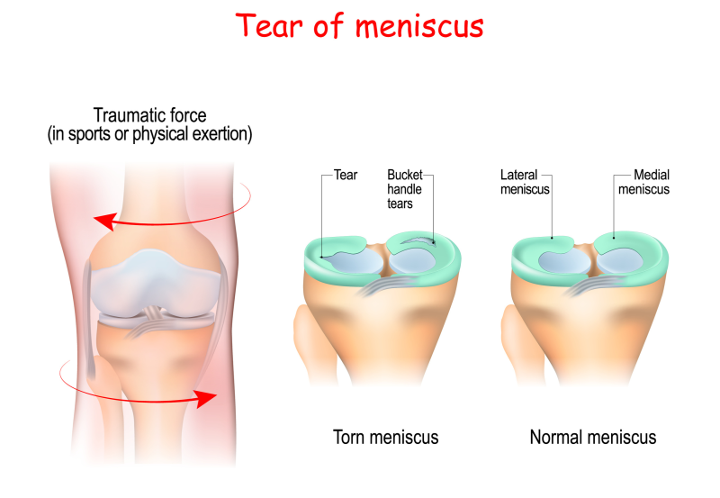 Meniscus Injury Treatment: The Role of Physiotherapy - Propel Physiotherapy